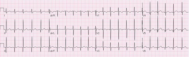 EKG Interpretation