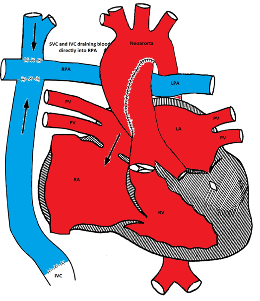 Cyanotic Cardiac Lesions