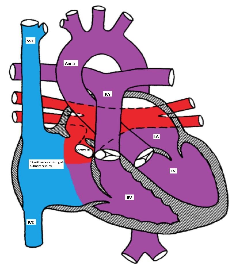 Cyanotic Cardiac Lesions