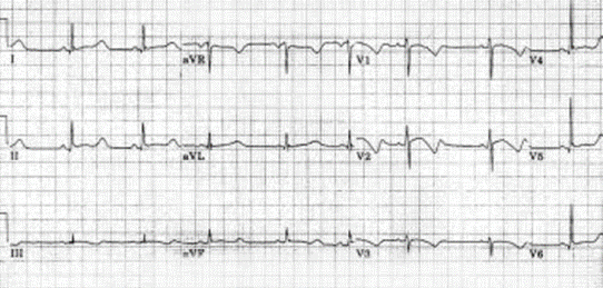 Long QT Syndrome (LQTS)