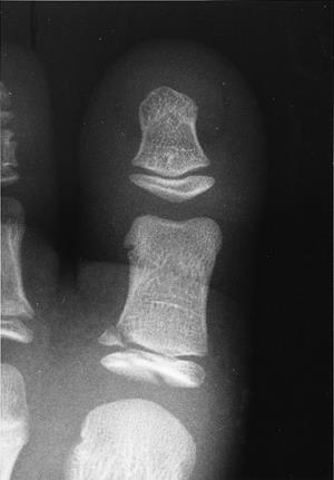 Fractures