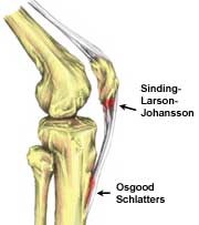 Knee Injuries